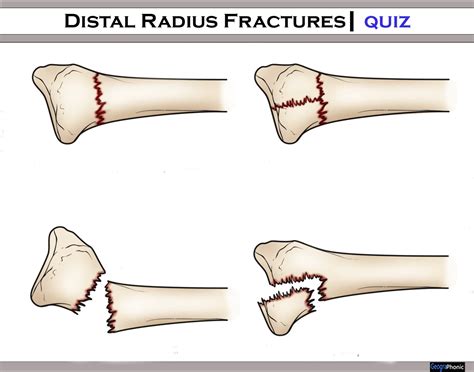 Distal Radius Fractures Quiz