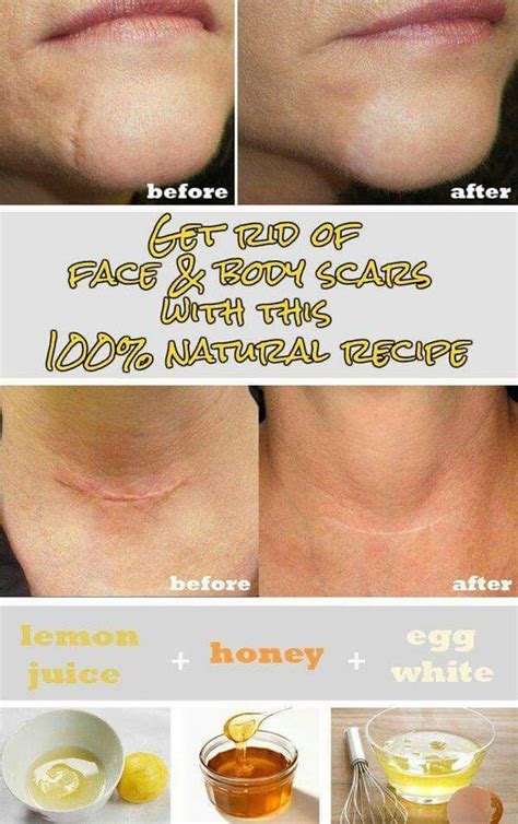 How To Get Rid Scars On Legs Professional And Home Remedies Artofit