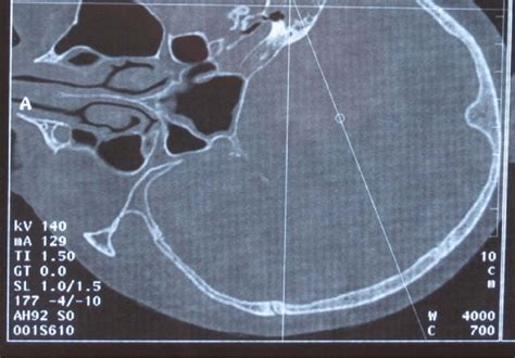 Ct Examination Of The Temporal Bones Demonstrated The Tumour Occupying Download Scientific