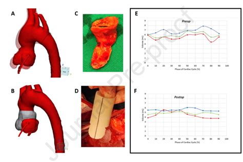 Pre And Post Operative 3d Segmentation Of The Aorta Showing Increased