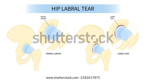 Hip Labral Tear Images Stock Photos Vectors Shutterstock
