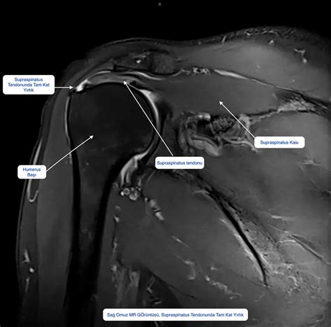 Supraspinatus Tendon Tears Diagnosis Treatment And Recovery 2026
