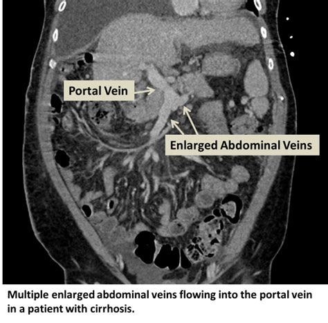Portal Hypertension Interventional Radiology Ucla Health