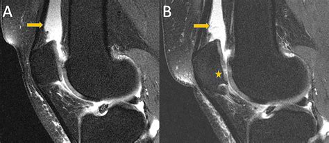 Impact Of Sustained Synovitis On Knee Joint Structural Degeneration 4