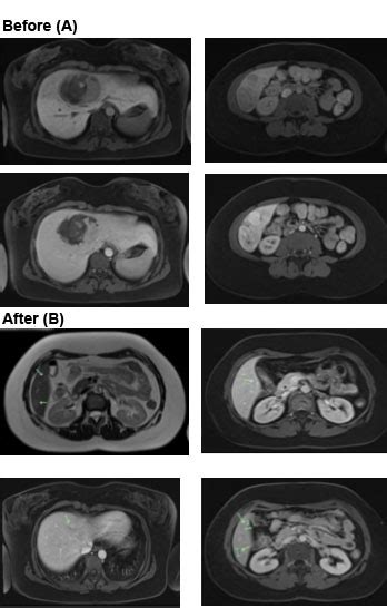 Conservative Management Of Hepatic Adenomas Journal Of Case Reports
