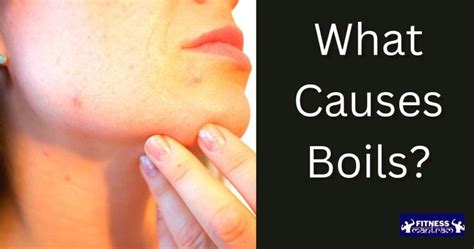 Vaginal Boils 25 Home Remedies For Boils On Private Area Female