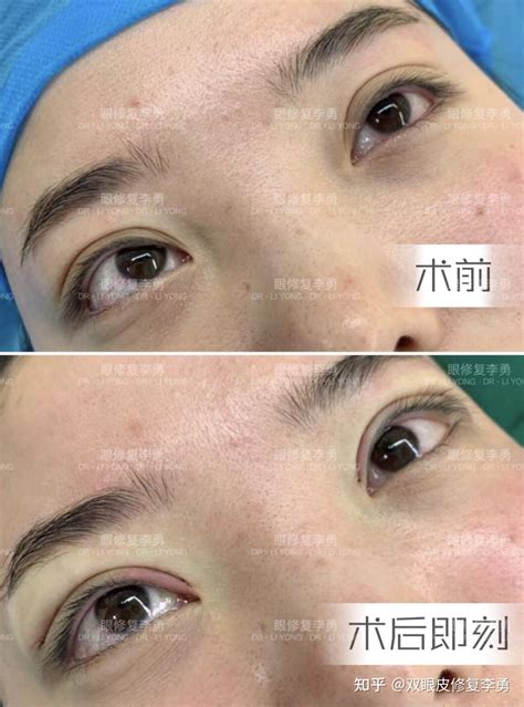 提肌失败的表现 知乎