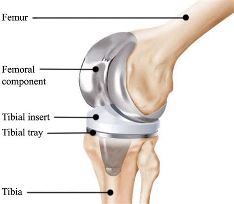 Knee Replacement Lawsuits Implant Failures