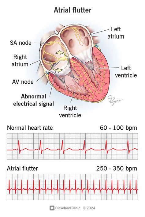 Atrial Flutter