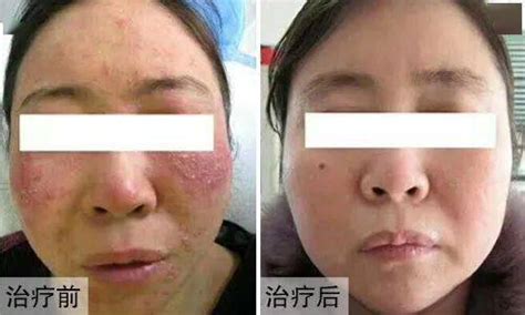 红斑病型天疱疮图片 搜狗图片搜索