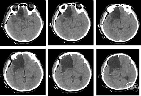 山东省肿瘤医院李峰教授：右侧额颞开颅经额入路超范围雕刻式最大程度安全切除巨大额岛叶胶质瘤 脑医汇
