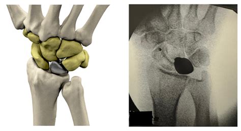 Carpal Bone Reconstruction Craniotech