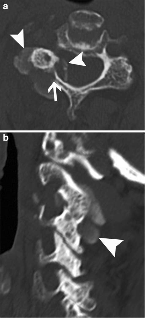Periarticular Soft Tissue Calcification Pacs