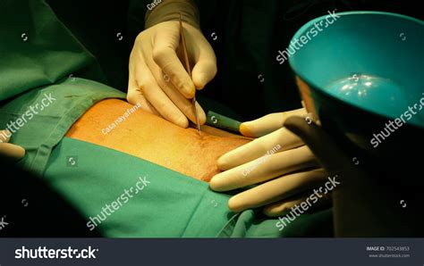 Skin Incision Inguinal Hernia Operation Foto De Stock Editar Ahora