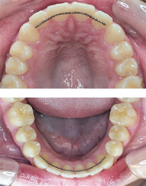 Permanent Retainer Leber Orthodontics Tucson Braces