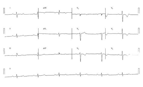 Medical Mystery Bradycardia The Answer NEJM
