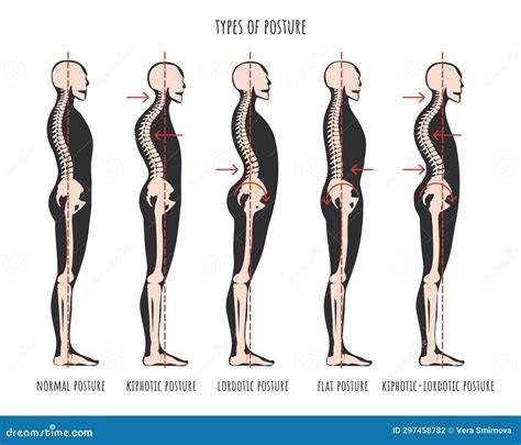 Get 33 Kyphosis Lordosis Posture Smartofpedia
