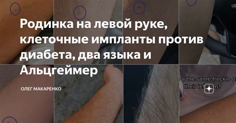Родинка на левой руке клеточные импланты против диабета два языка и Альцгеймер Олег