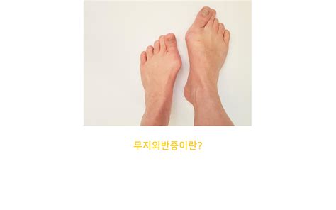 웰본정형외과 무지외반증