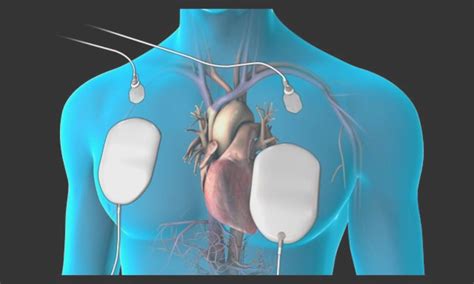 Dsed And Vc Defibrillation Tied To Higher Survival Compared To Standard