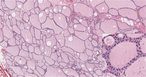 Thyroid Normal Histology Nus Pathweb Nus Pathweb