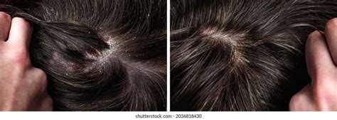 Dry Scalp Flakes