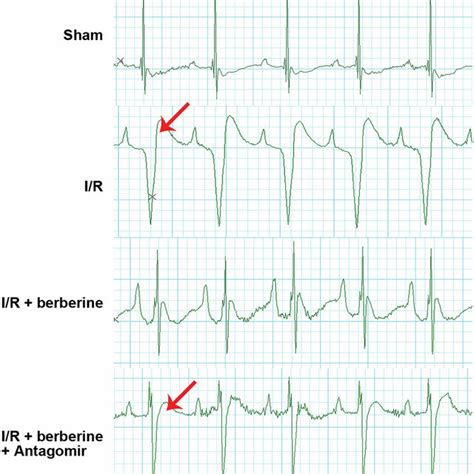 Berberine Improved Ecg Pattern In Ir Rats By Inducing The Level Of