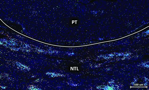 Exemplary Section Of A Multiplex Stained Tissue Sample With Hcc Primary Download Scientific