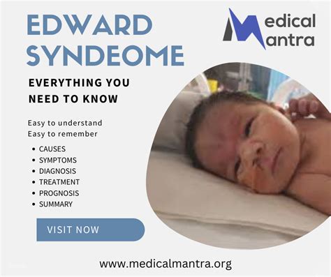 Edward Syndrome Trisomy 18 Causes Symptoms Diagnosis Treatment And Management Medical