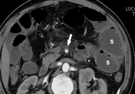 Small Bowel Obstruction What To Look Forradiographics