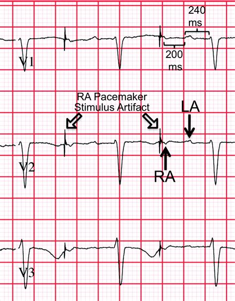 Marked Interatrial And Atrioventricular Conduction Delay With Enhanced