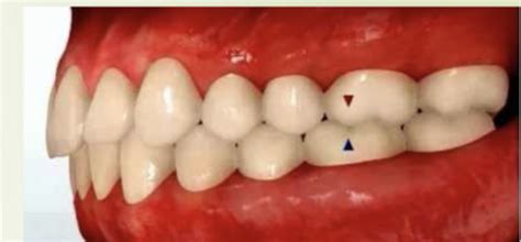 Tmj Flashcards Quizlet