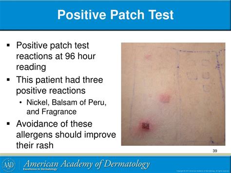 Ppt Contact Dermatitis Powerpoint Presentation Free Download Id