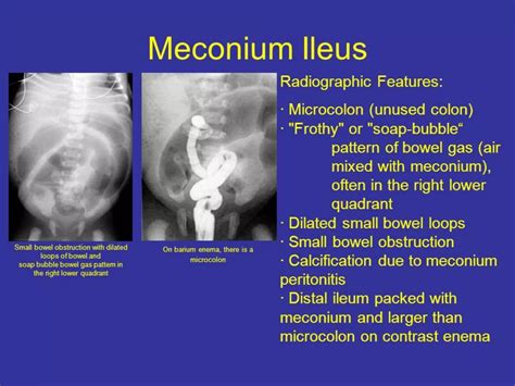Meconium Ileus Simple Pptx