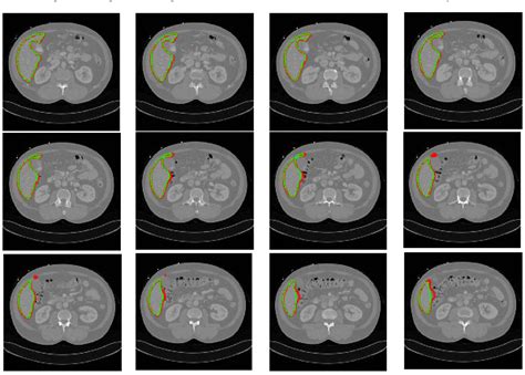 Figure 2 From A Modified Distance Regularized Level Set Model For Liver Segmentation From Ct