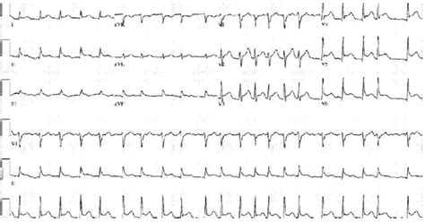 Ekg Showing Diffuse St Elevation Except V1 V2 And V3 With St Download Scientific Diagram