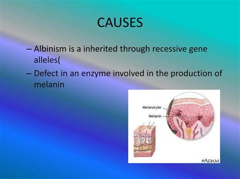 Ppt Albinism Powerpoint Presentation Free Download Id2478002