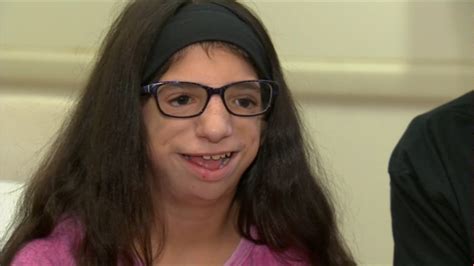 Treacher Collins Syndrome Wonder The World Has Been Bad To Me The