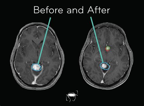 Brain Tumor Types Glioblastoma Meningioma And More