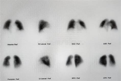 Lung Ventilation Perfusion Imaging Normal VQ Scan Stock Photo Image Of Embolism Nuclear