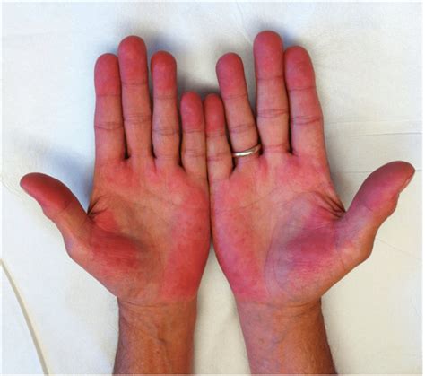 Top 28 Wallpapers Palmar Erythema Red Palms Liver Disease Photos Stunning