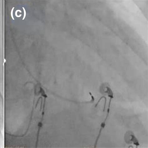 A Angiography Showed An Occluded Left Subclavian Vein B Download Scientific Diagram