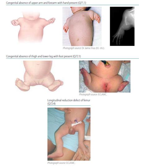 Congenital Limb Deficiency