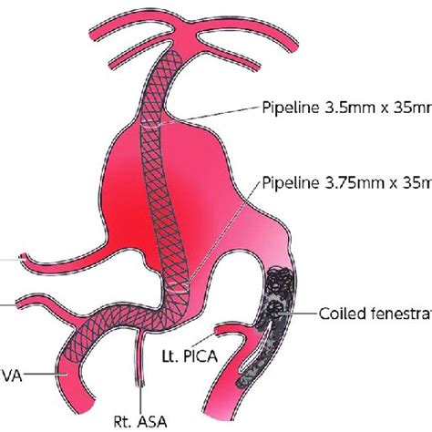 A Schematic Diagram Showing Arbitrary Segmentation Of The Carotid Download Scientific Diagram