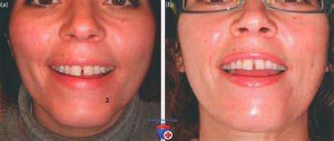 Осложнения коррекции асимметрии нижней губы при улыбке инъекциями ботулотоксина