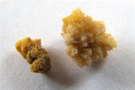 Gouty Tophi Causes Symptoms Diagnosis And Treatment