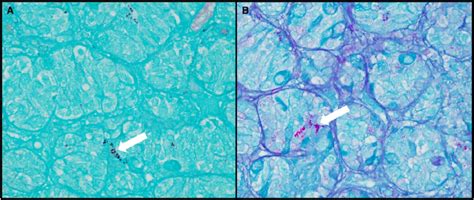 Ill Defined Granulomas And Clusters Of Small Extracellular White