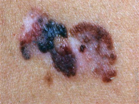 ¿qué Debo Saber Sobre El Cáncer De Piel Dermacaribe