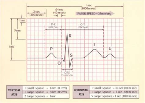 Ekg Nsr Meaning Sinus Rhythm On Ekg Alis