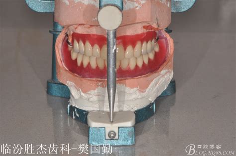上下颌活动义齿修复 临汾胜杰齿科 樊国勤的博客 KQ88口腔博客